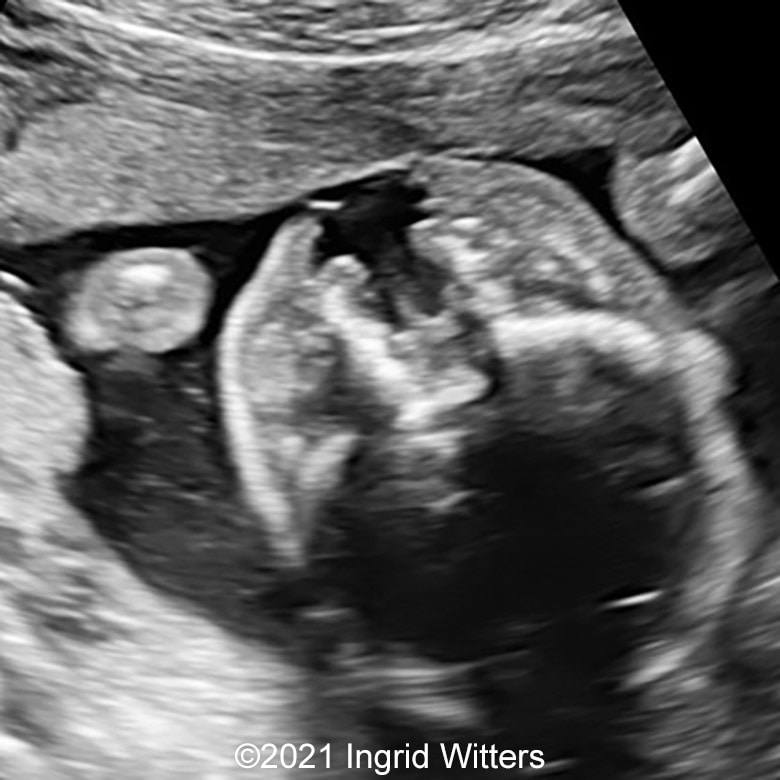 📃 Multiple congenital anomalies due to an unbalanced translocation 1p36 ...