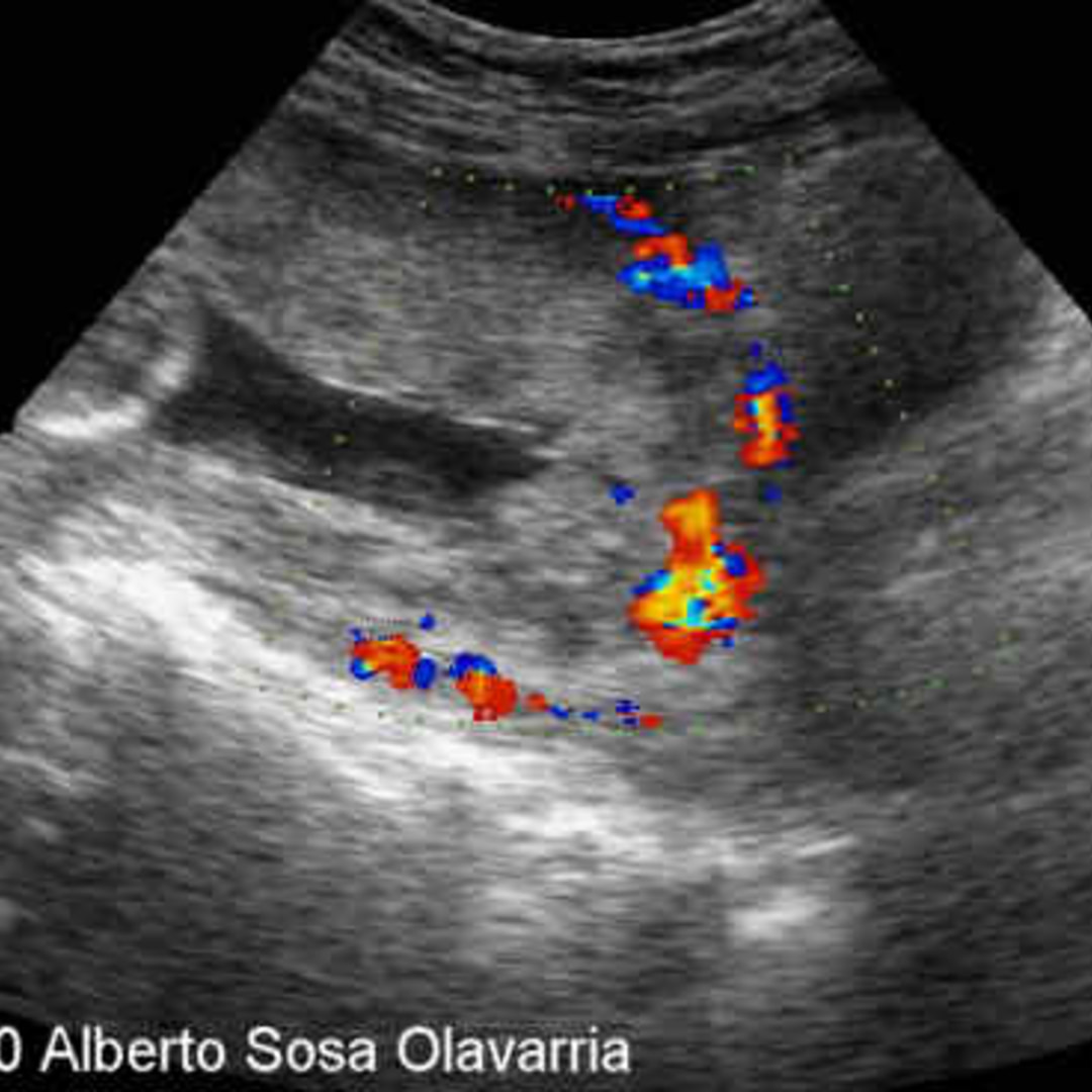 📃 Placenta percreta