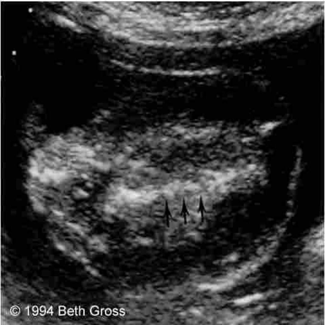 📃 Twin reversed arterial perfusion (acardiac), amorphus