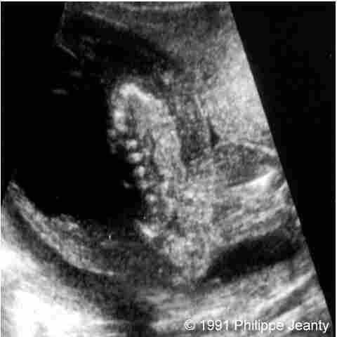 📃 Twin, acardiac, ultrasound-guided embolization
