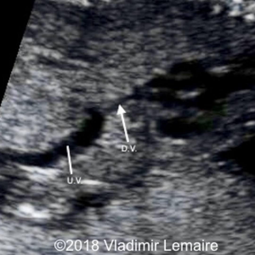 ductus venosus waveform abnormal