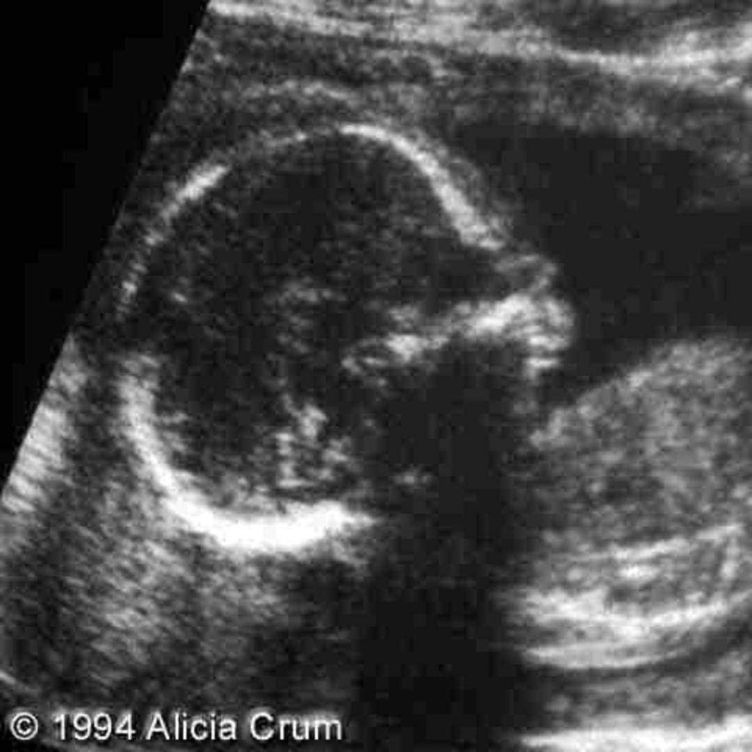 📃 Femoral hypoplasia - unusual facies syndrome