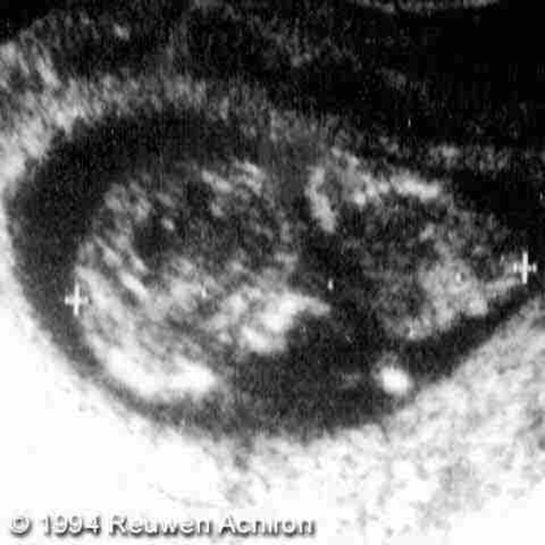 📃 Holoprosencephaly: alobar