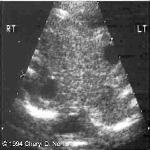 📃 Twins, conjoined, thoraco-omphalopagus