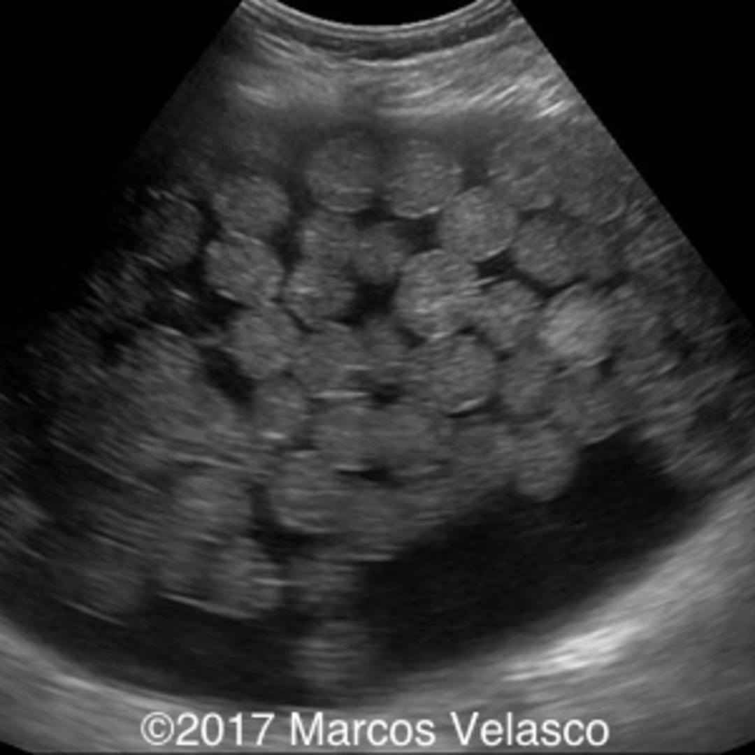 ๐ Mature Ovarian Teratoma