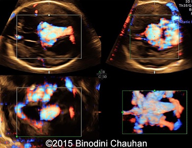 📃 Vein of Galen aneurysm