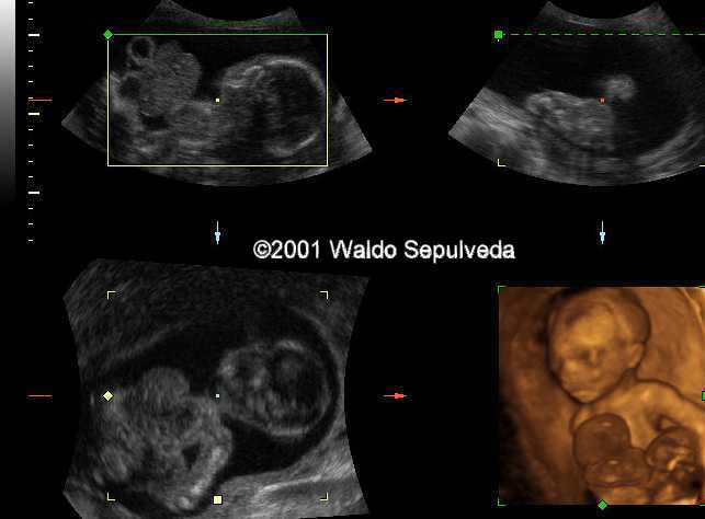 📃 Limb-body-wall complex, 3D