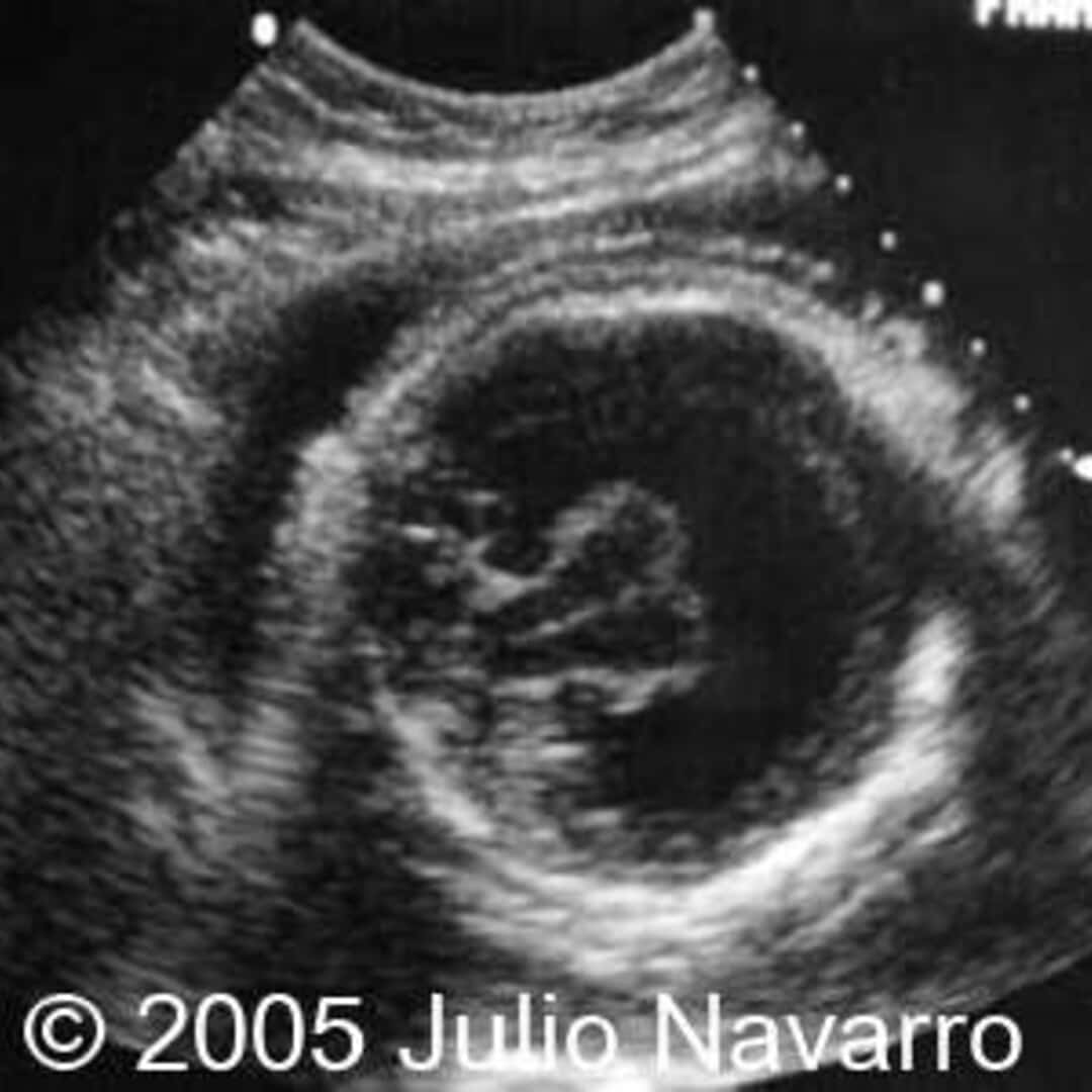 📃 Holoprosencephaly, alobar