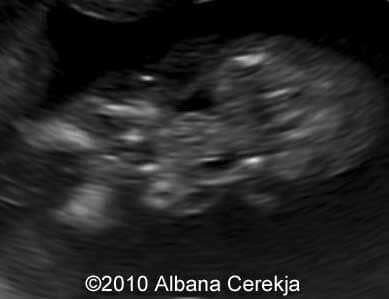📃 Cystic hygroma with single umbilical artery