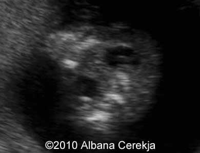 📃 Cystic hygroma with single umbilical artery