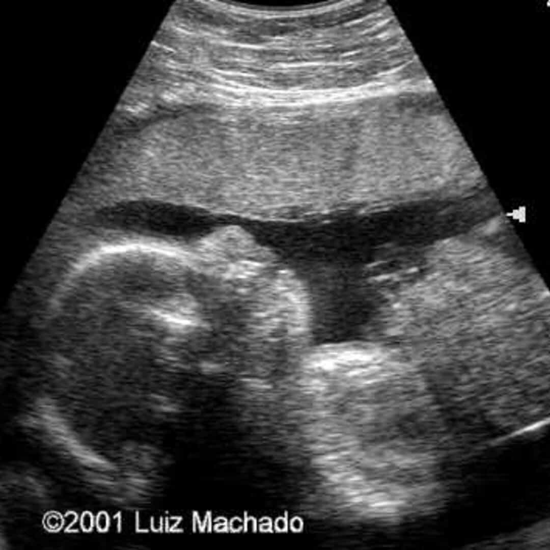 📃 Limb-body-wall complex & amorphus acardiac