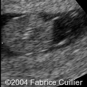 📃 Limb body wall complex