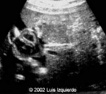 📃 Limb body stalk anomaly