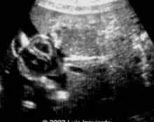 📂 Limb body stalk anomaly