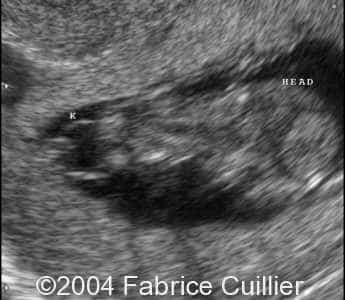 📃 Limb body wall complex