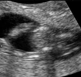 📃 Limb body wall complex