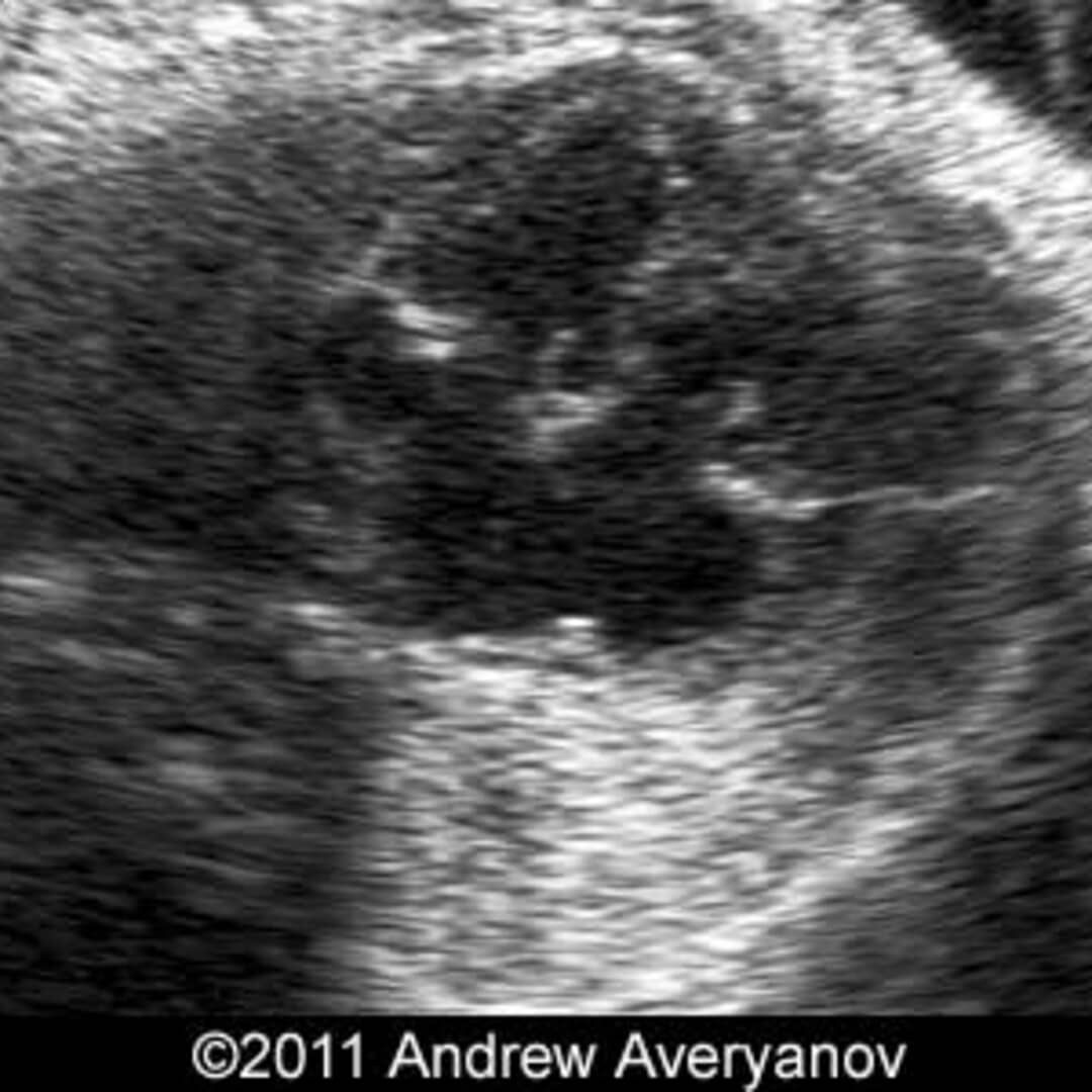 📃 Left atrial isomerism