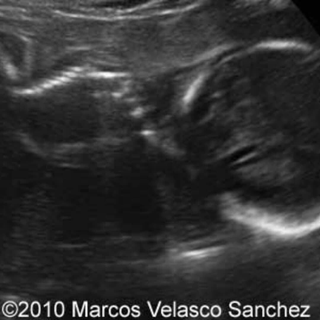 📃 Body stalk anomaly