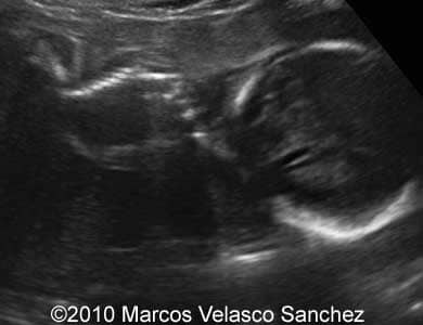 📃 Body stalk anomaly