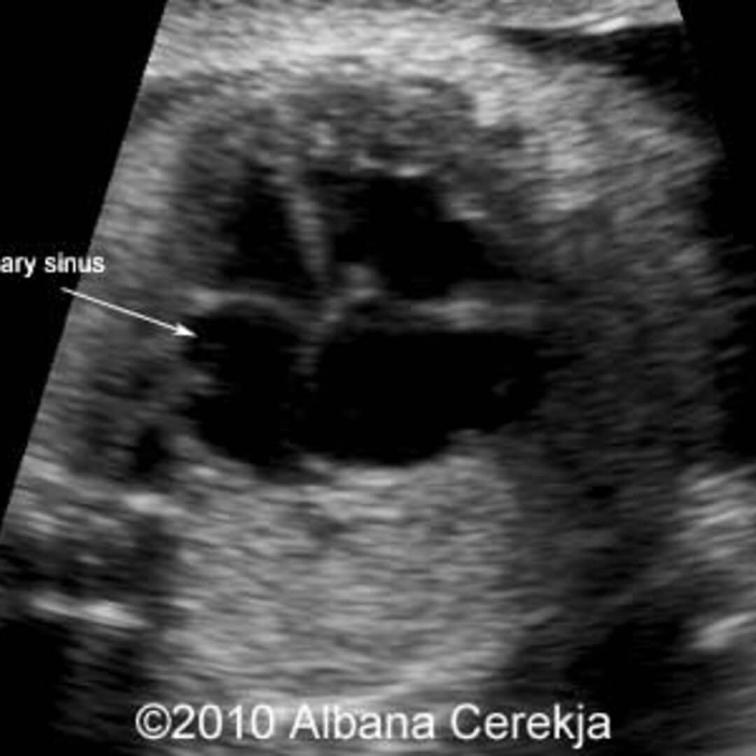 📃 Persistent left superior vena cava