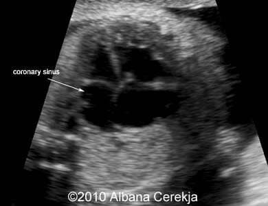 📃 Persistent left superior vena cava