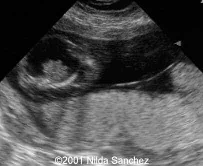 📃 TRAP, with rudimentary heart