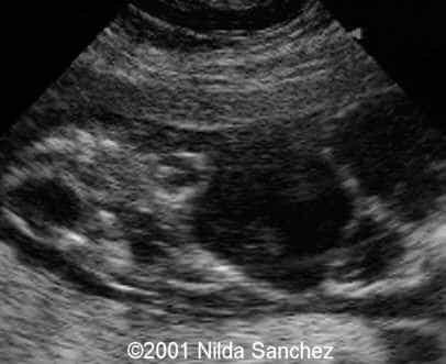 📃 TRAP, with rudimentary heart