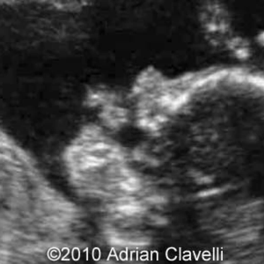 📃 Midline facial cleft