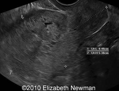 📃 Complete molar pregnancy