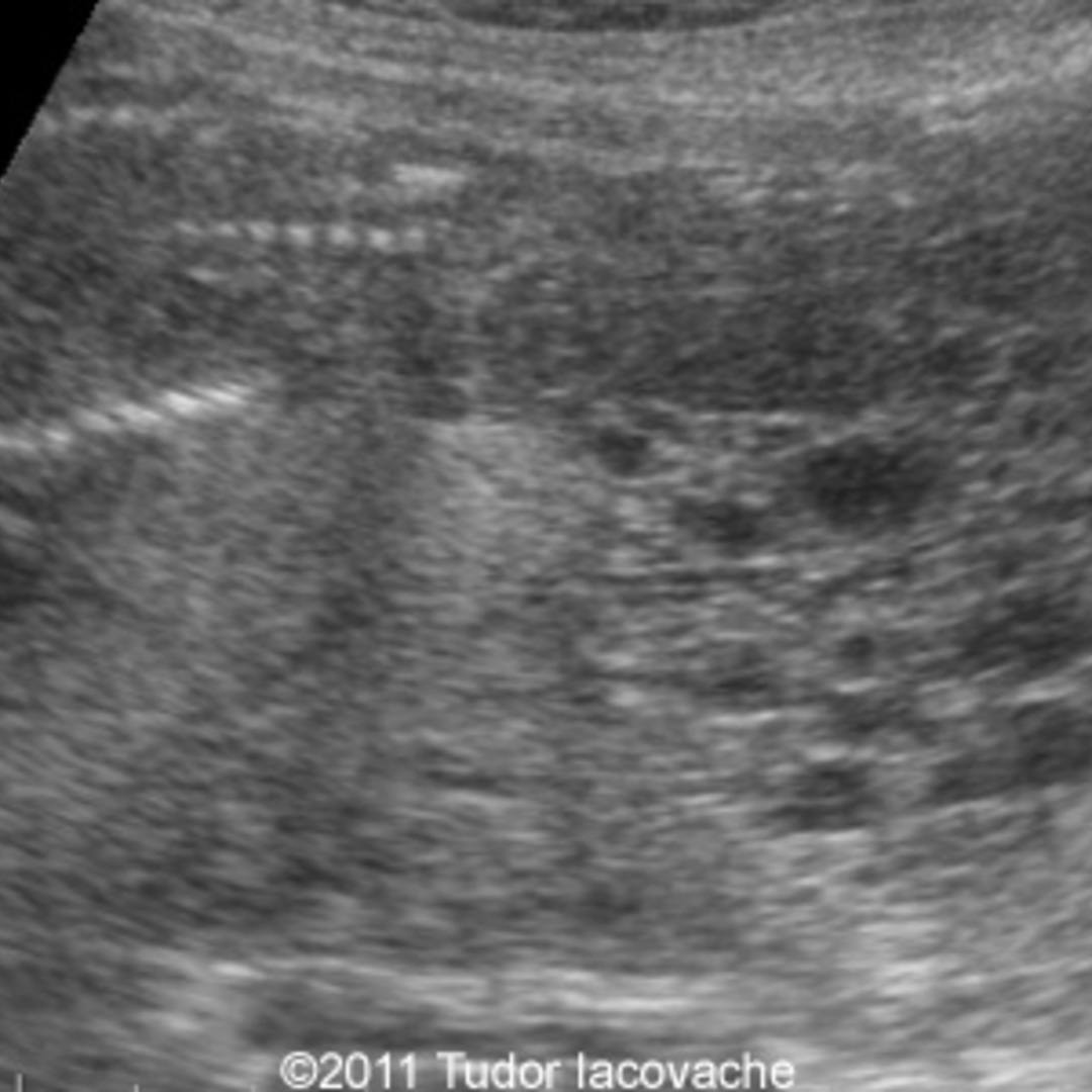 📃 Complete hydatidiform mole