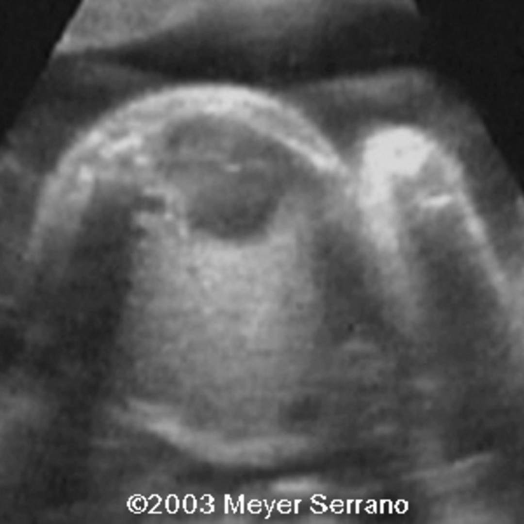 📃 Malrotation of the gut