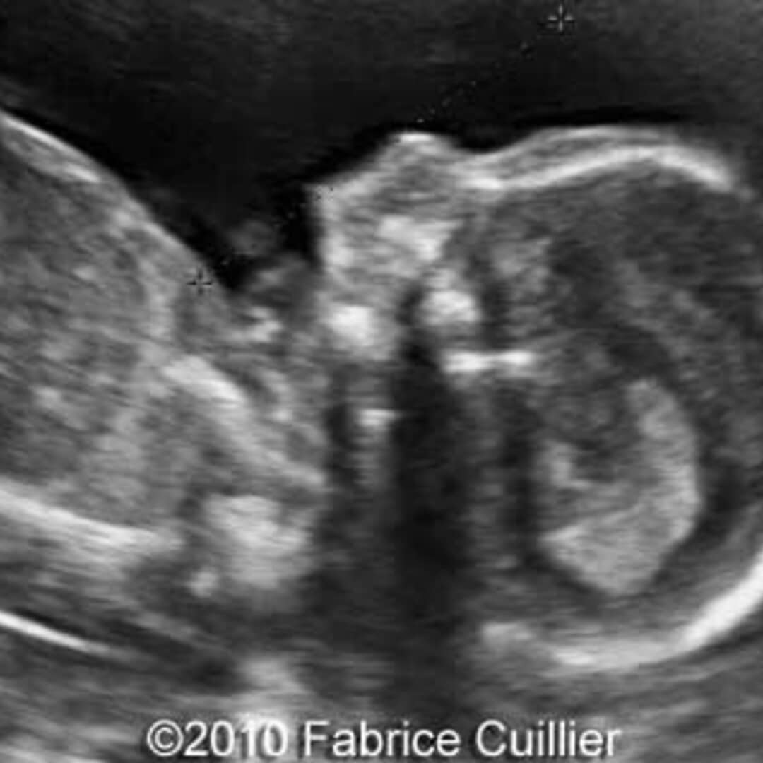 Osteogenesis Imperfecta Karyotype Osteogenesis Imperfecta Type II: