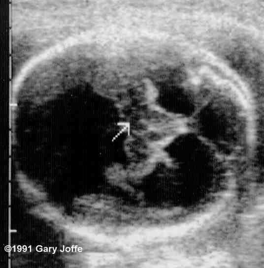 📃 Agnathia-holoprosencephaly