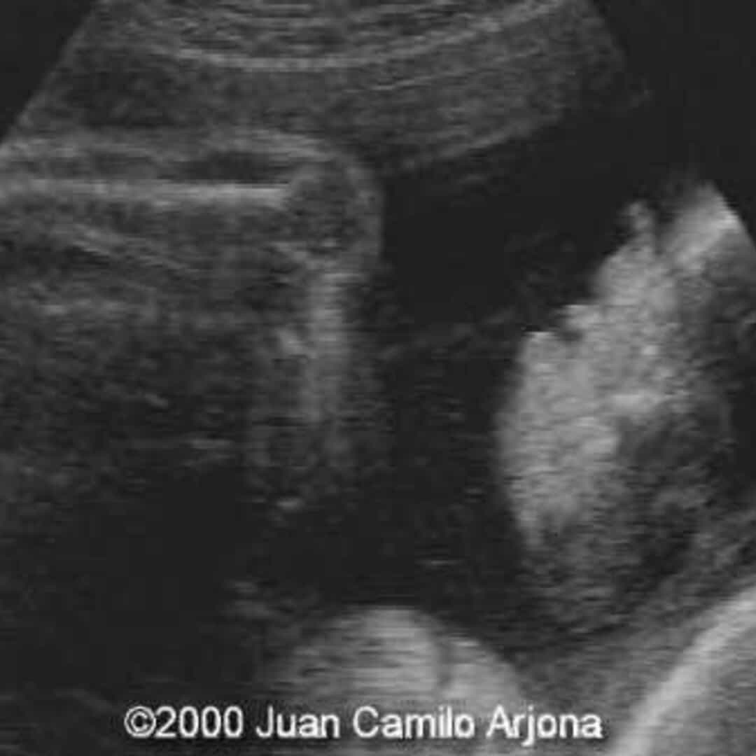 📃 Goldenhar syndrome