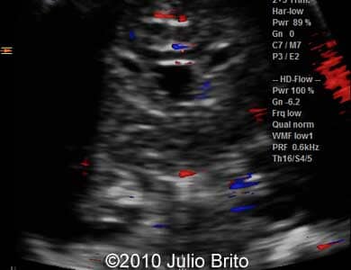 📃 Pericallosal artery