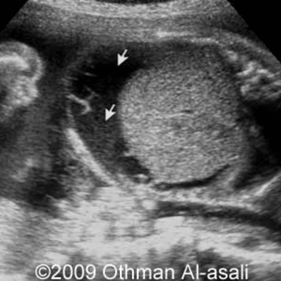 📃 Jejunal obstruction and meconium peritonitis