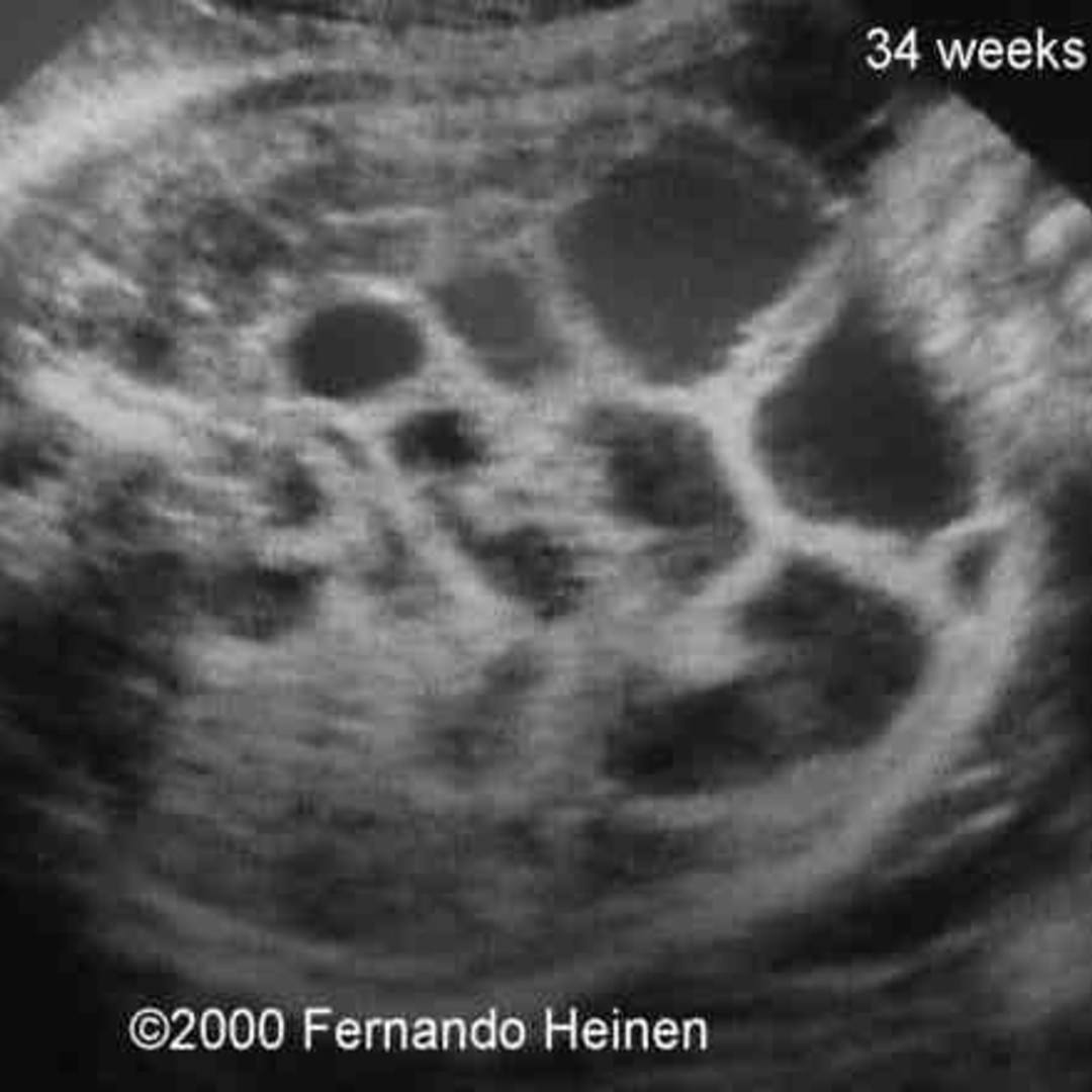 📃 Jejunal atresia