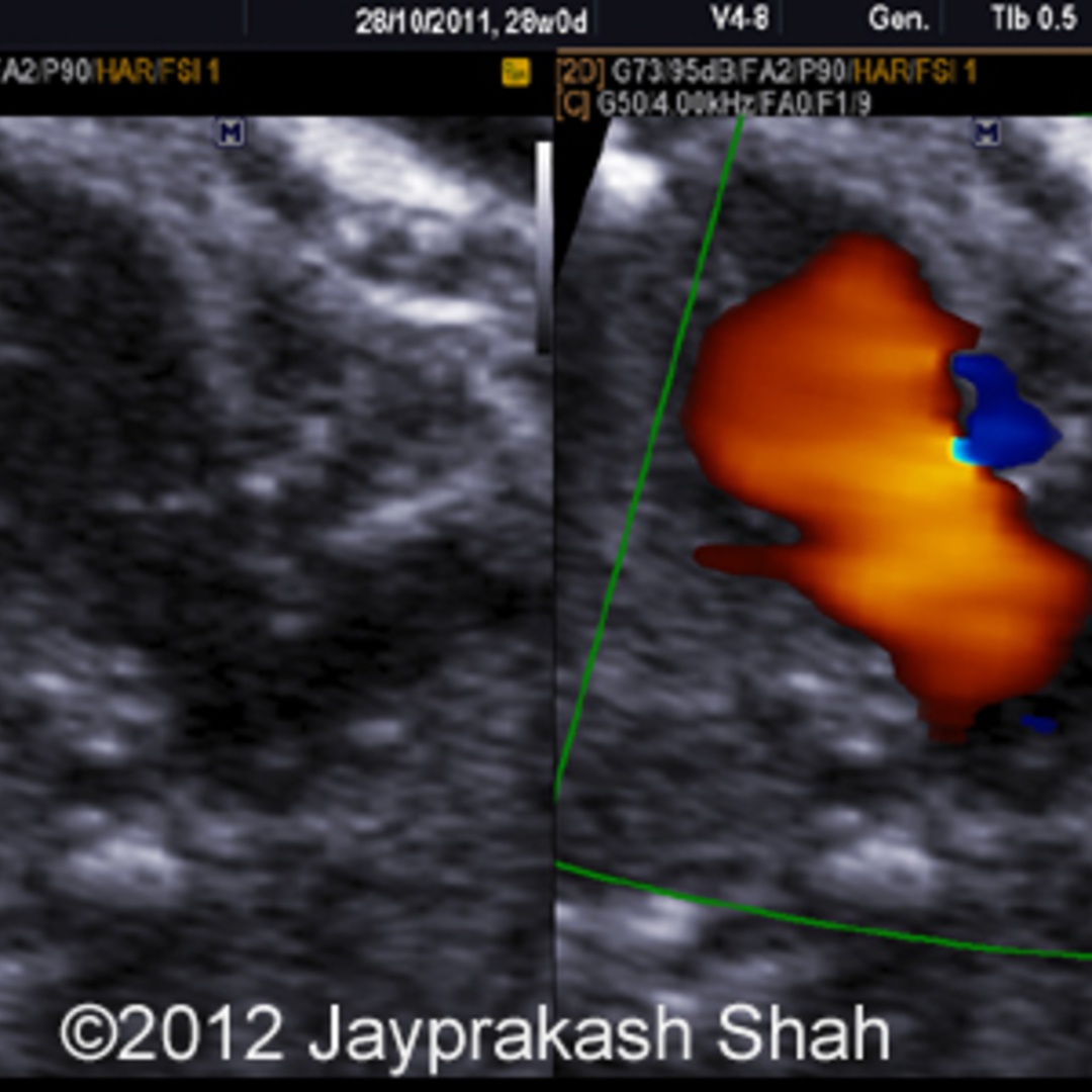 📃 Hypoplastic right heart syndrome