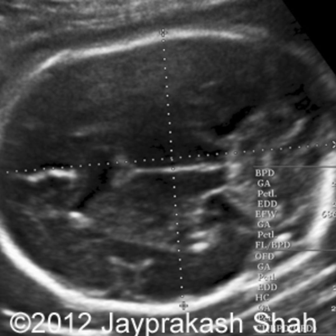 📃 Isolated septo-optic dysplasia