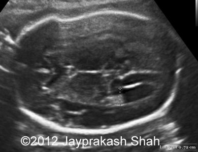 📃 Isolated septo-optic dysplasia