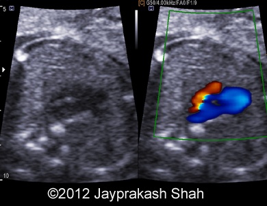 📃 Hypoplastic right heart syndrome