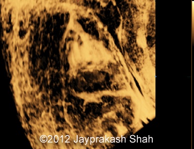 📃 Hypoplastic right heart syndrome