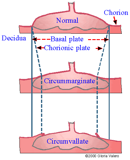 📃 Placenta circumvallate
