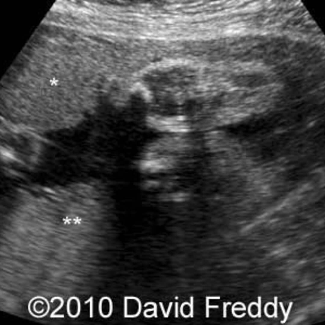 📃 Bilobate placenta