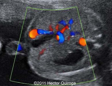 📃 Persistent right umbilical vein