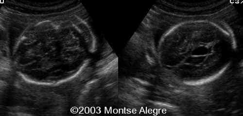 📃 Arachnoid Cyst