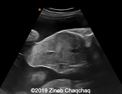 📃 Rachischisis totalis