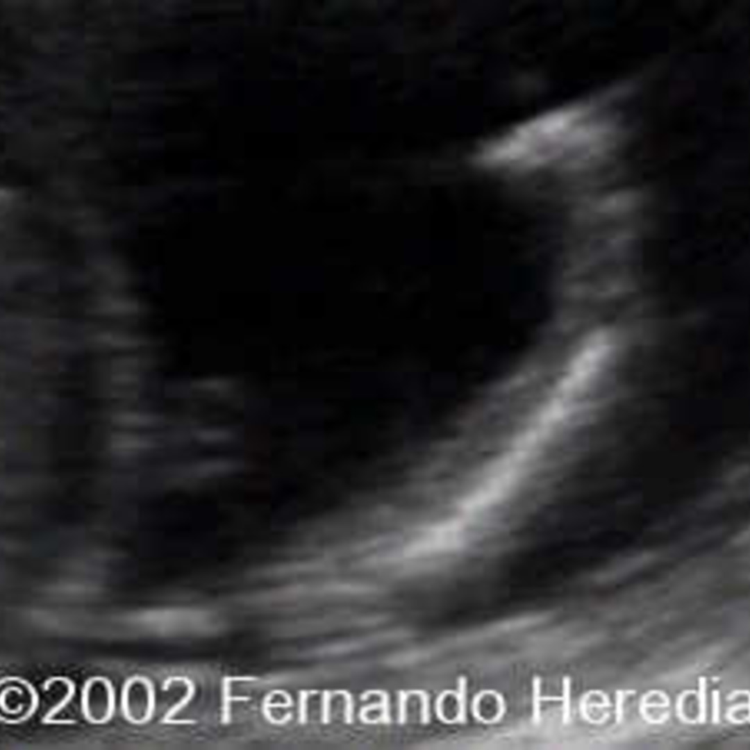 📃 Trisomy 18, bilateral radial aplasia