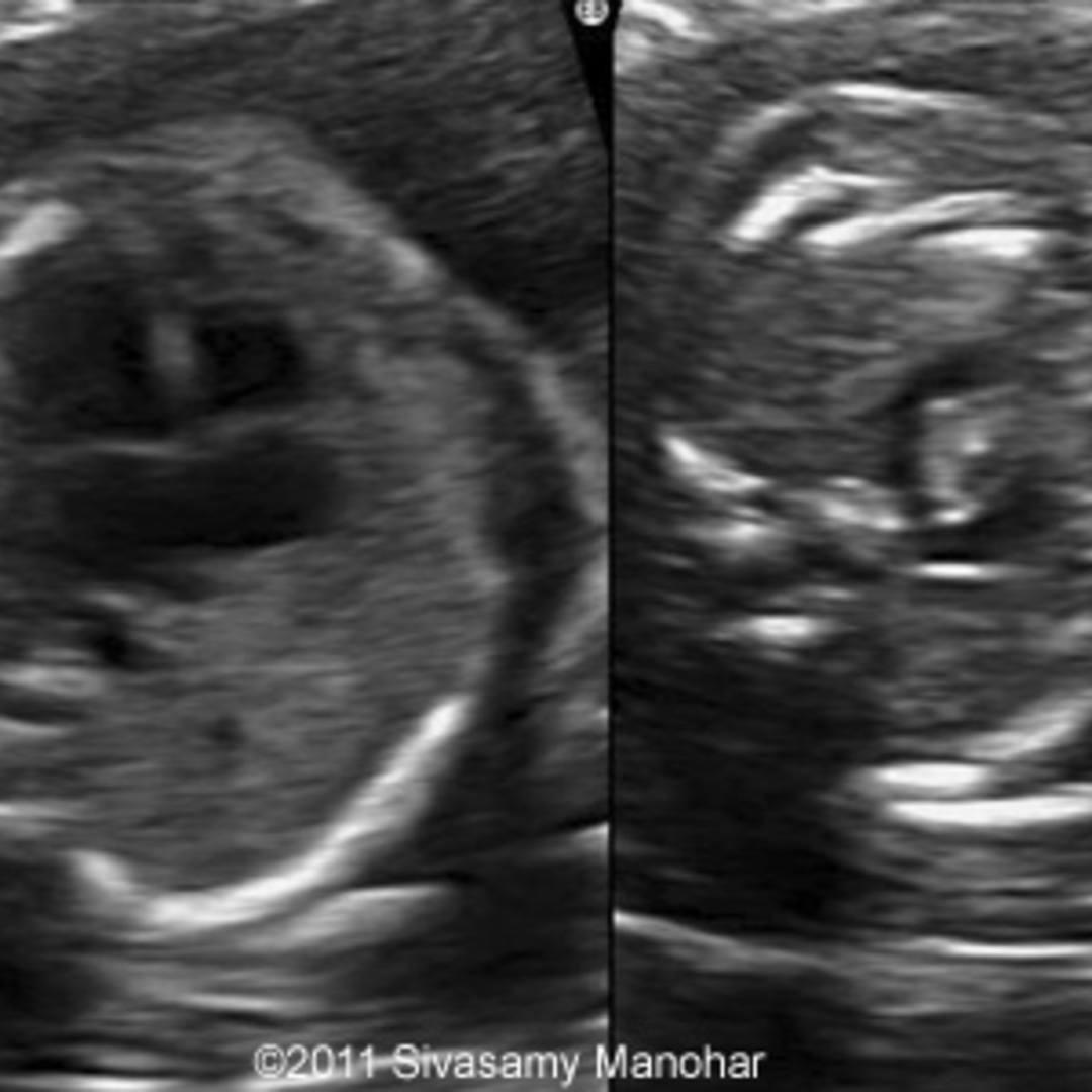 📃 Right aortic arch