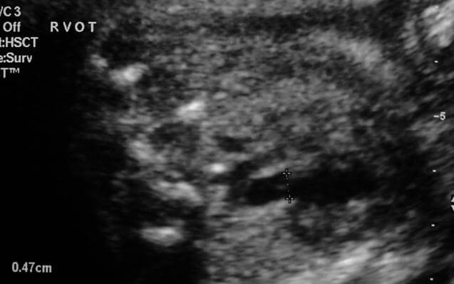 📃 Coarctation of the aorta